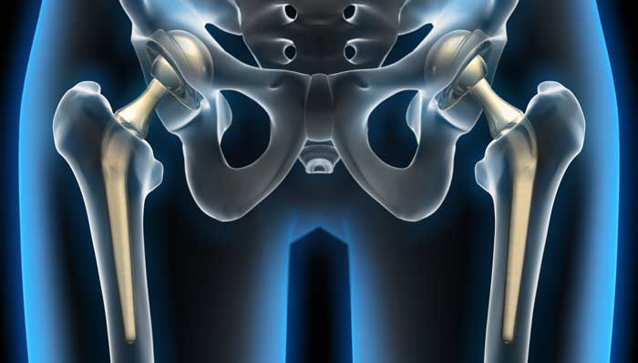 Revisión y recambio de prótesis de cadera ¿cuándo se hace?