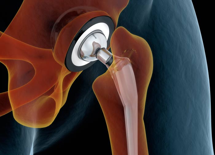 Abordaje quirúrgico de prótesis de cadera vs cicatriz