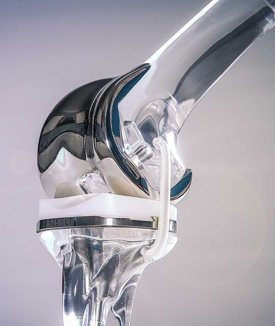 Cirugía de prótesis de rodilla | Todo sobre la intervención