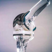 Las prótesis de rodilla | ¡Todo lo que debes saber!