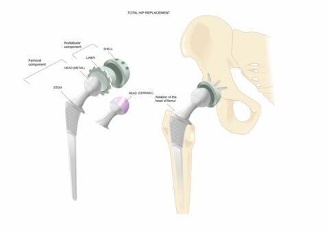 Materiales y componentes de una prótesis de cadera