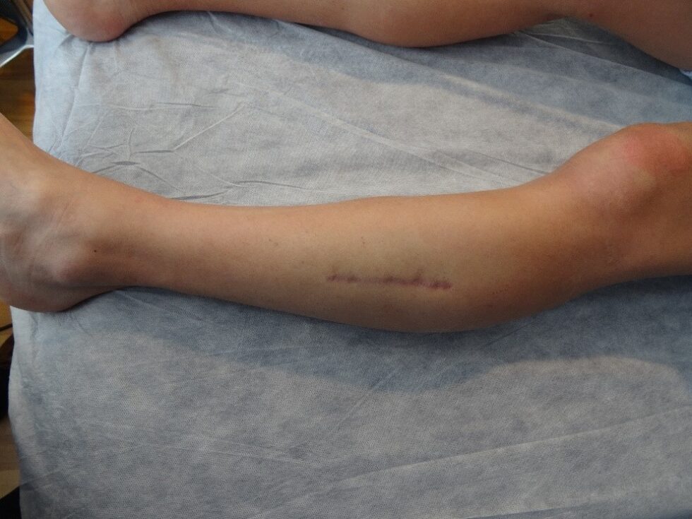 Síndrome compartimental fasciotomía y tratamiento